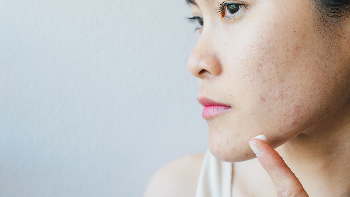 Acne Scarring | DERM Lab | North Vancouver